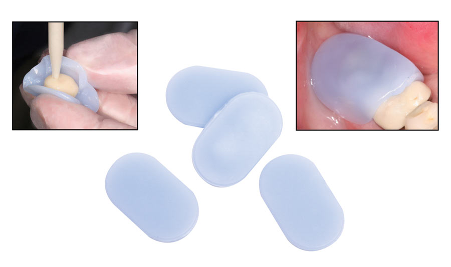 Temp Tabs - American Dental Accessories, Inc.