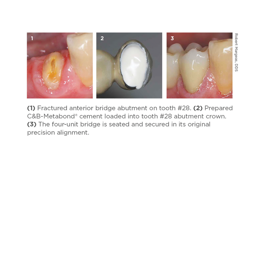 C&B Metabond Quick Cement - American Dental Accessories, Inc.