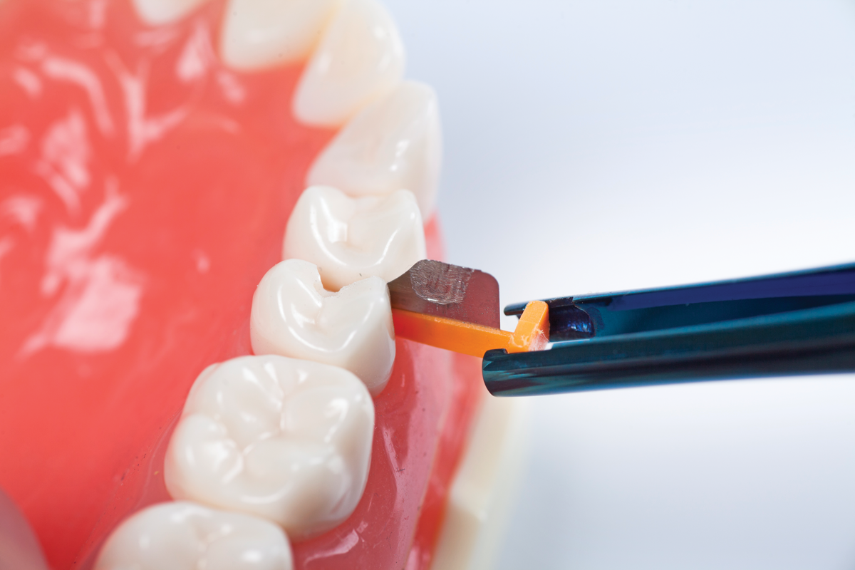 Directa FenderWedge Kit - American Dental Accessories, Inc.