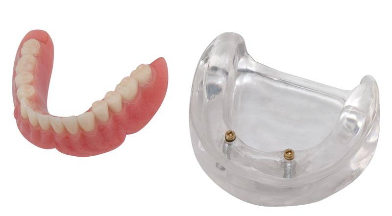 Locator Zest Denture Model - 2 Implants - American Dental Accessories, Inc.